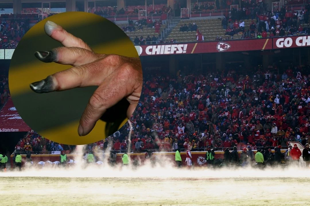 Multiple Fans Receiving Amputations After Icy Chiefs Playoff Game
