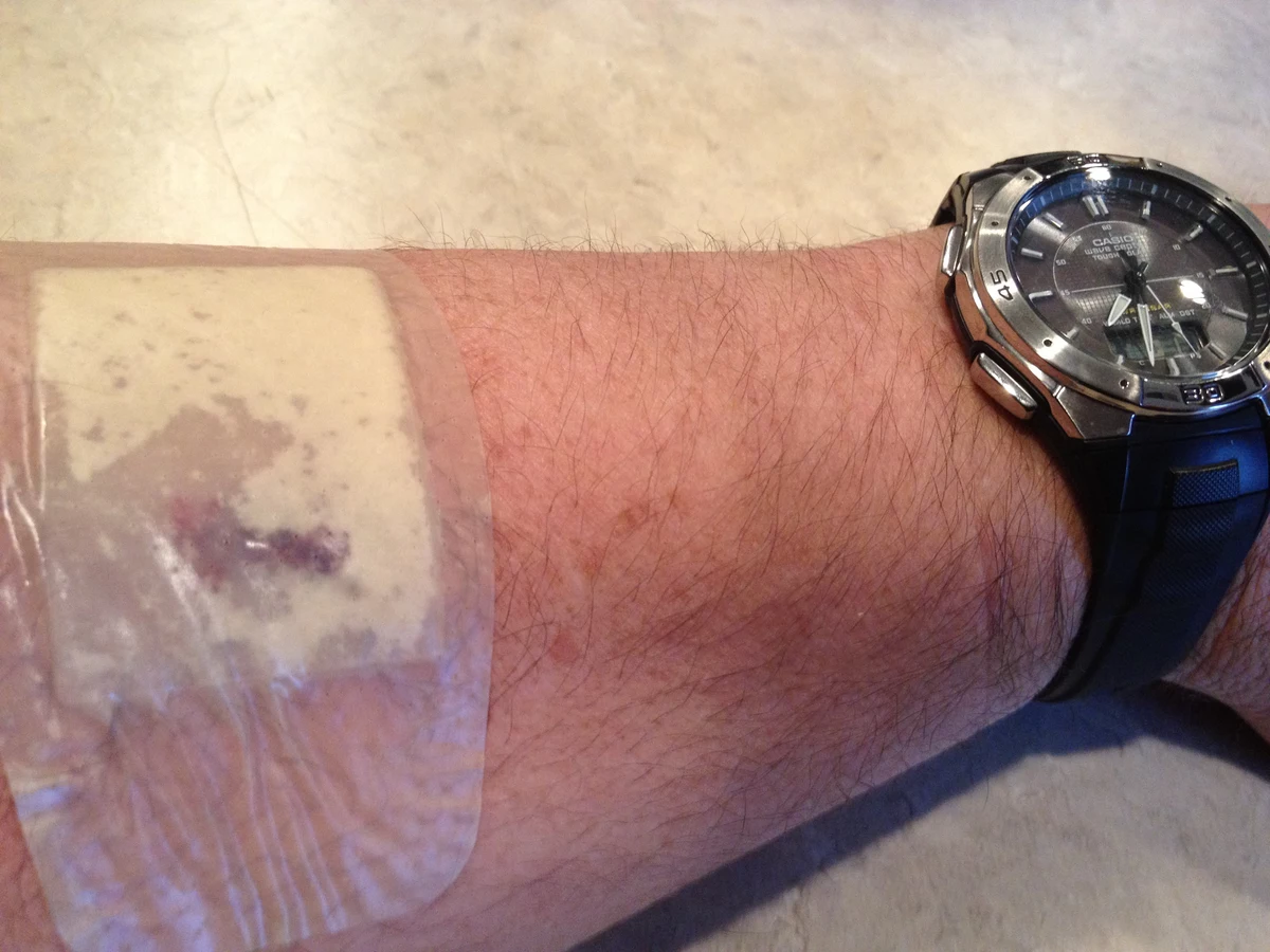 That Spot On My Arm Was Cancer that-spot-on-my-arm-was-cancer