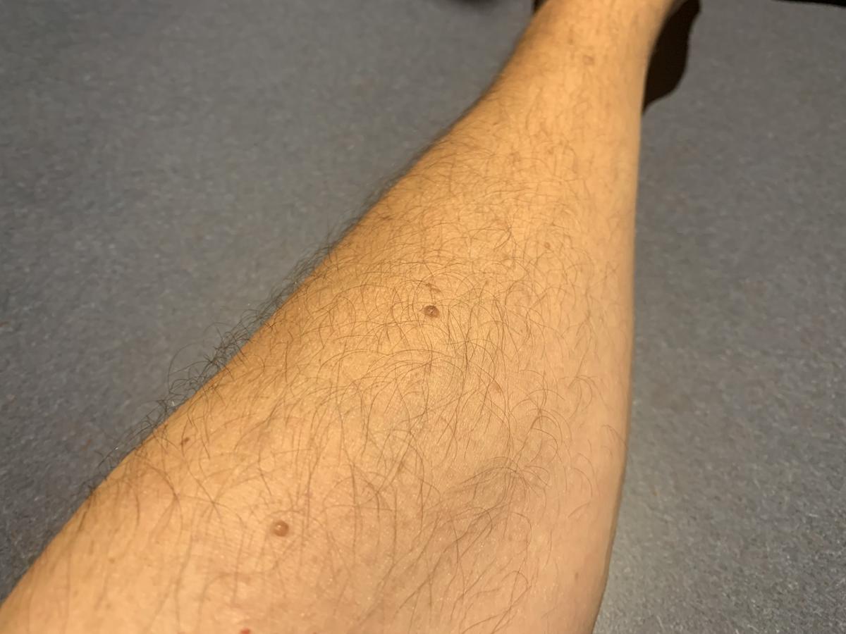 Dudes of Connecticut: Do You Have a Freckle on Your Left Arm?